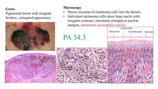 Skin ( basal cell carcinoma, malignant melanoma etc.) | PDF