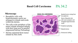 Skin ( basal cell carcinoma, malignant melanoma etc.) | PDF