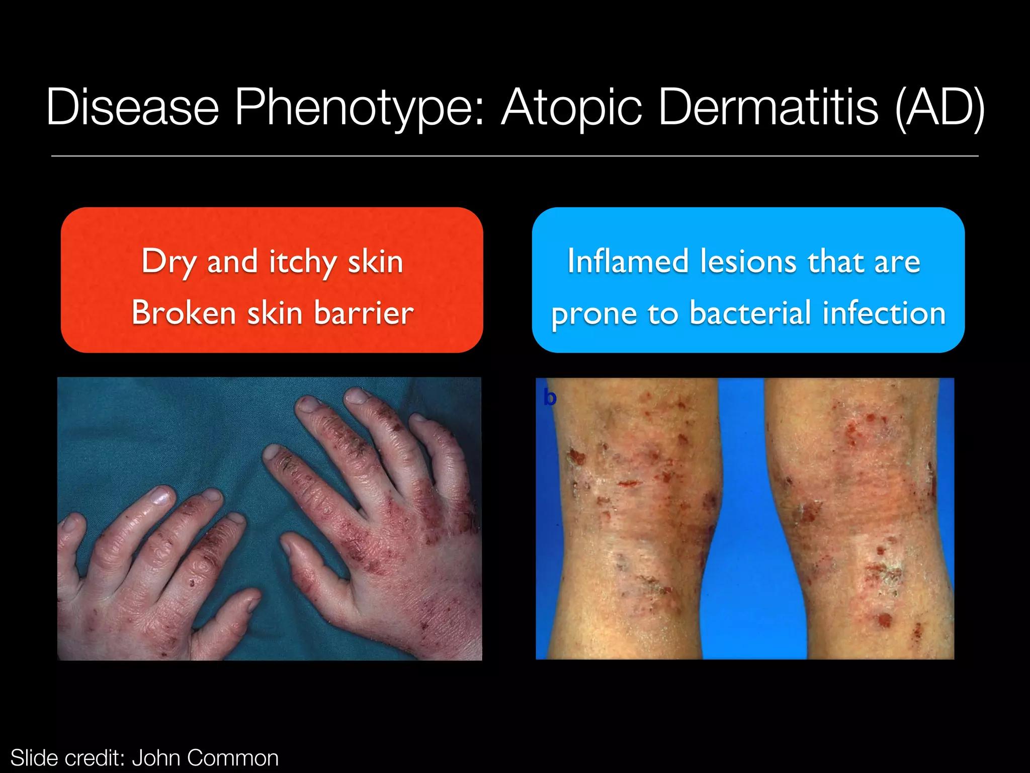 The Role of the Skin Microbiome in Atopic Dermatitis (Eczema) | PDF