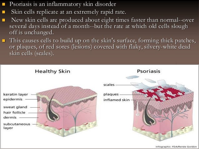 Skin Ailments Psoriasis