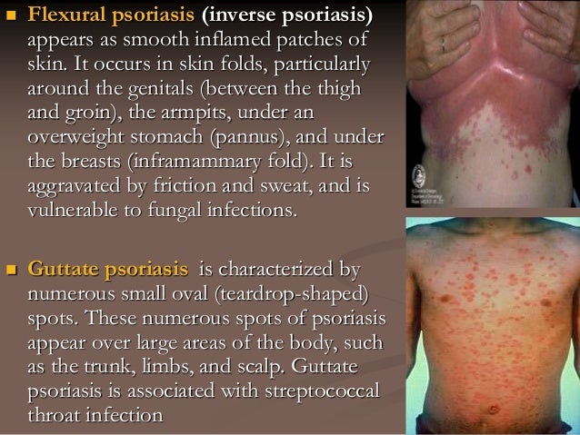 Skin Ailments Psoriasis