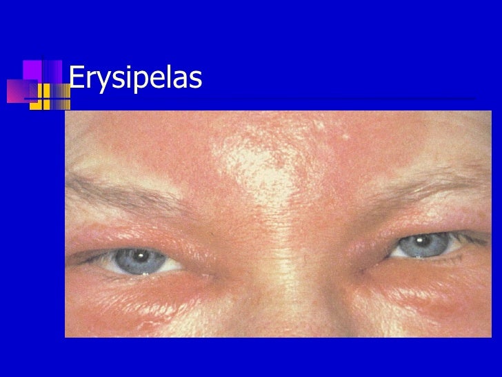 Erysipelas Children
