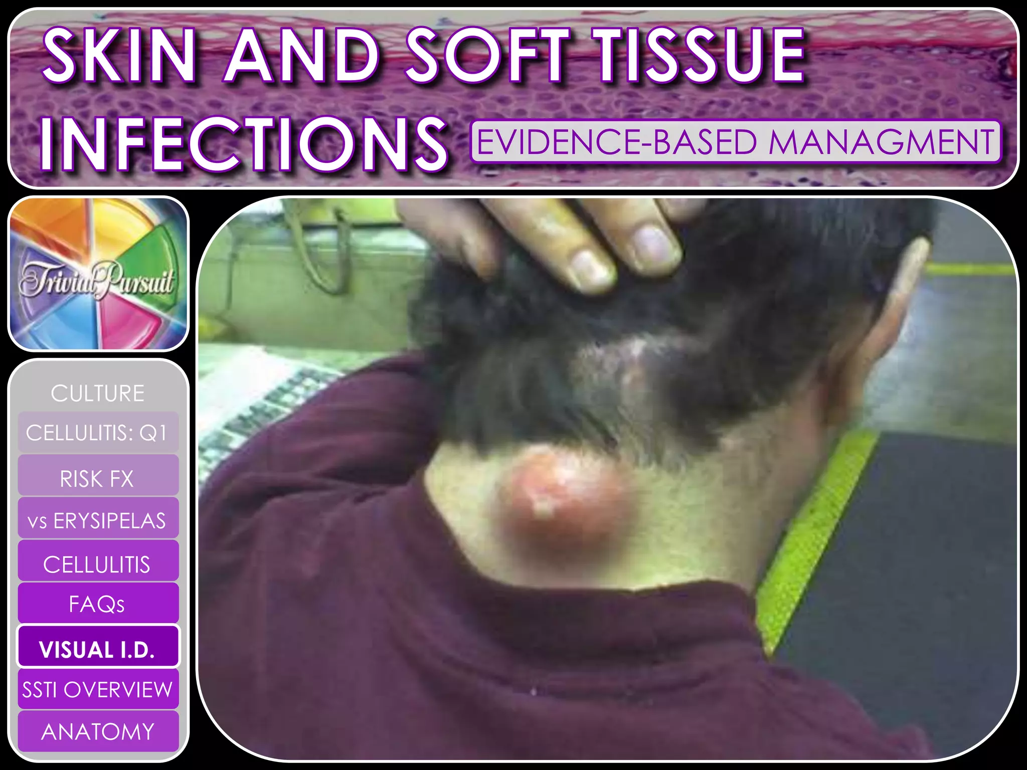Skin and Soft Tissue Infections | PPTX