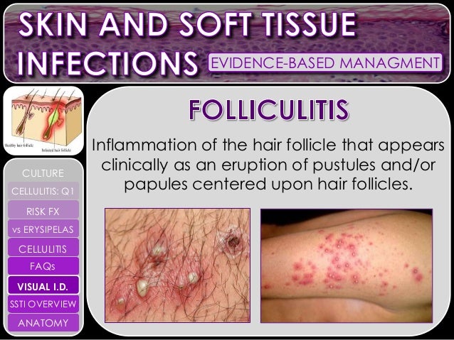Skin and Soft Tissue Infections