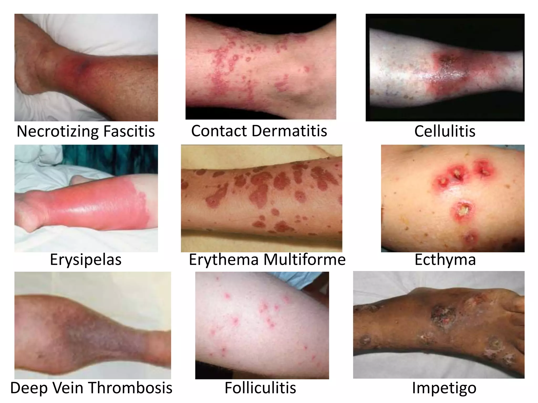Skin and soft tissue infections | PPTX