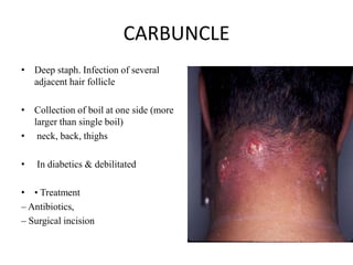 Skin and soft tissue infections | PPTX