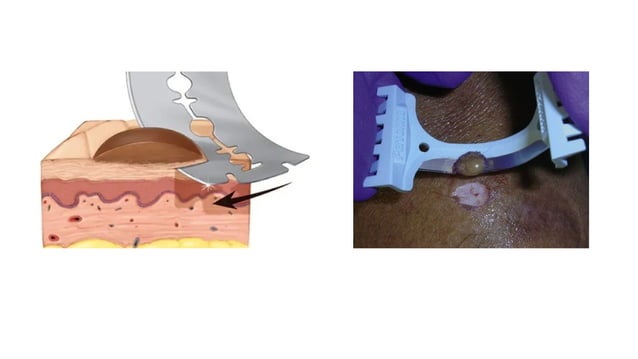 Skin Biopsy Types and Indications when to do | PPTX | Skin and ...