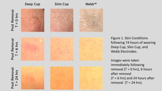 EEG Electrode Shape Affects Skin Safety and Breakdown for Longer ...