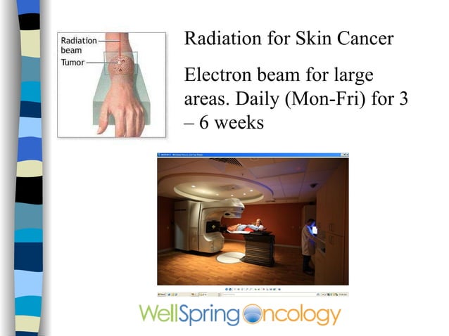 Skin Cancer | PPT