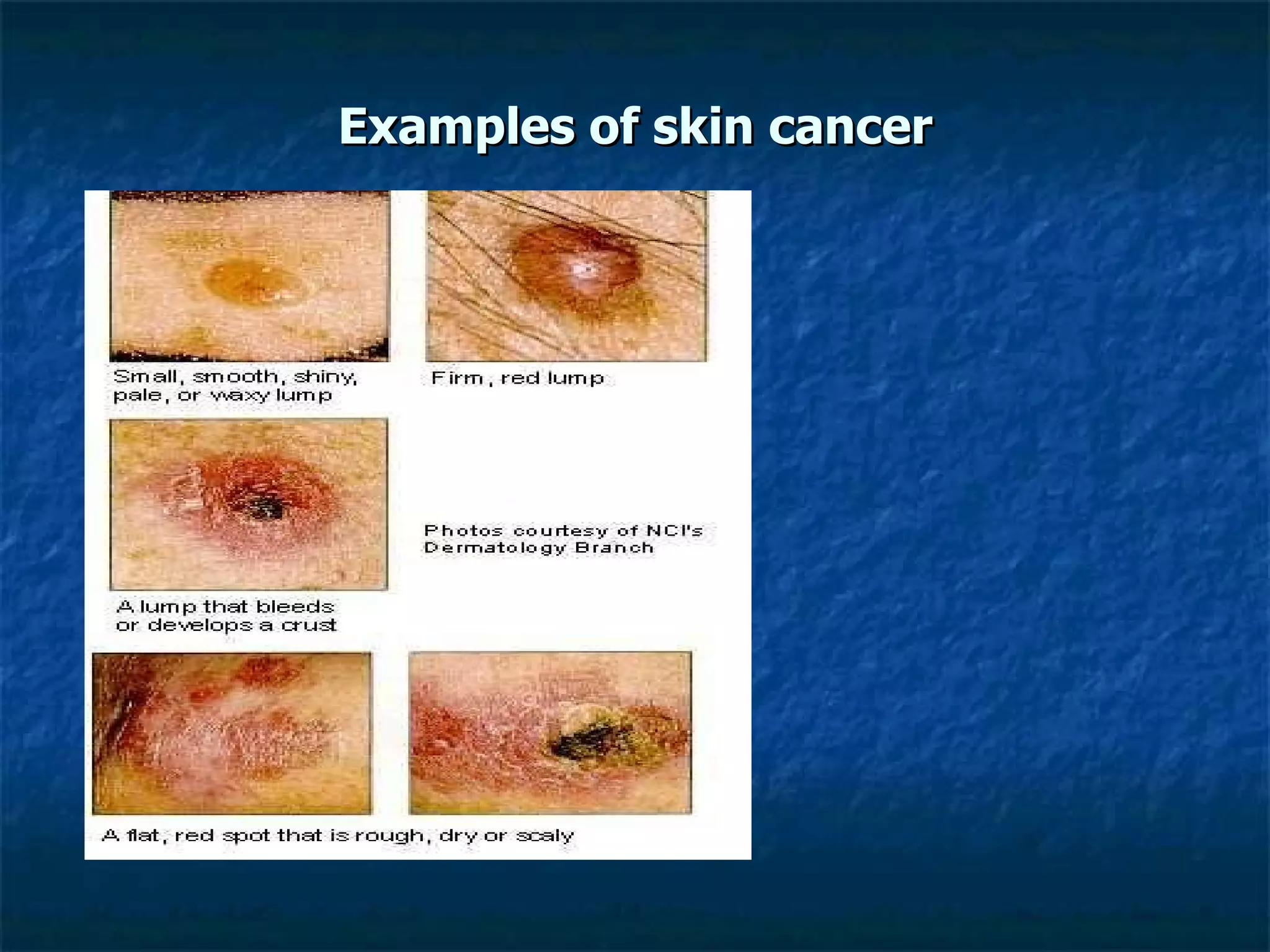Skin Cancer | PPT
