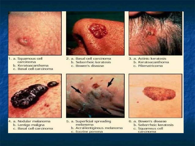 Skin Cancer | PPT
