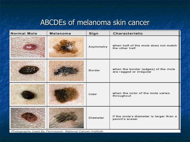 Skin Cancer | PPT