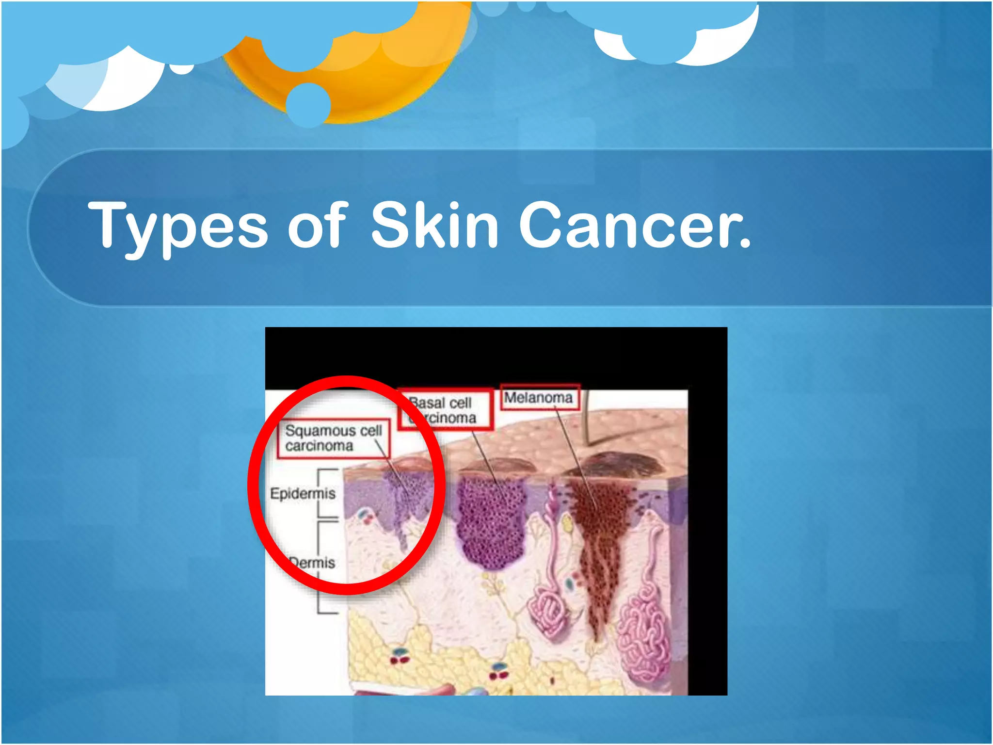 Skin cancer | PPTX