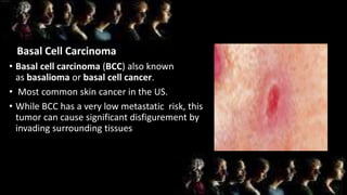 Skin cancer | PPTX