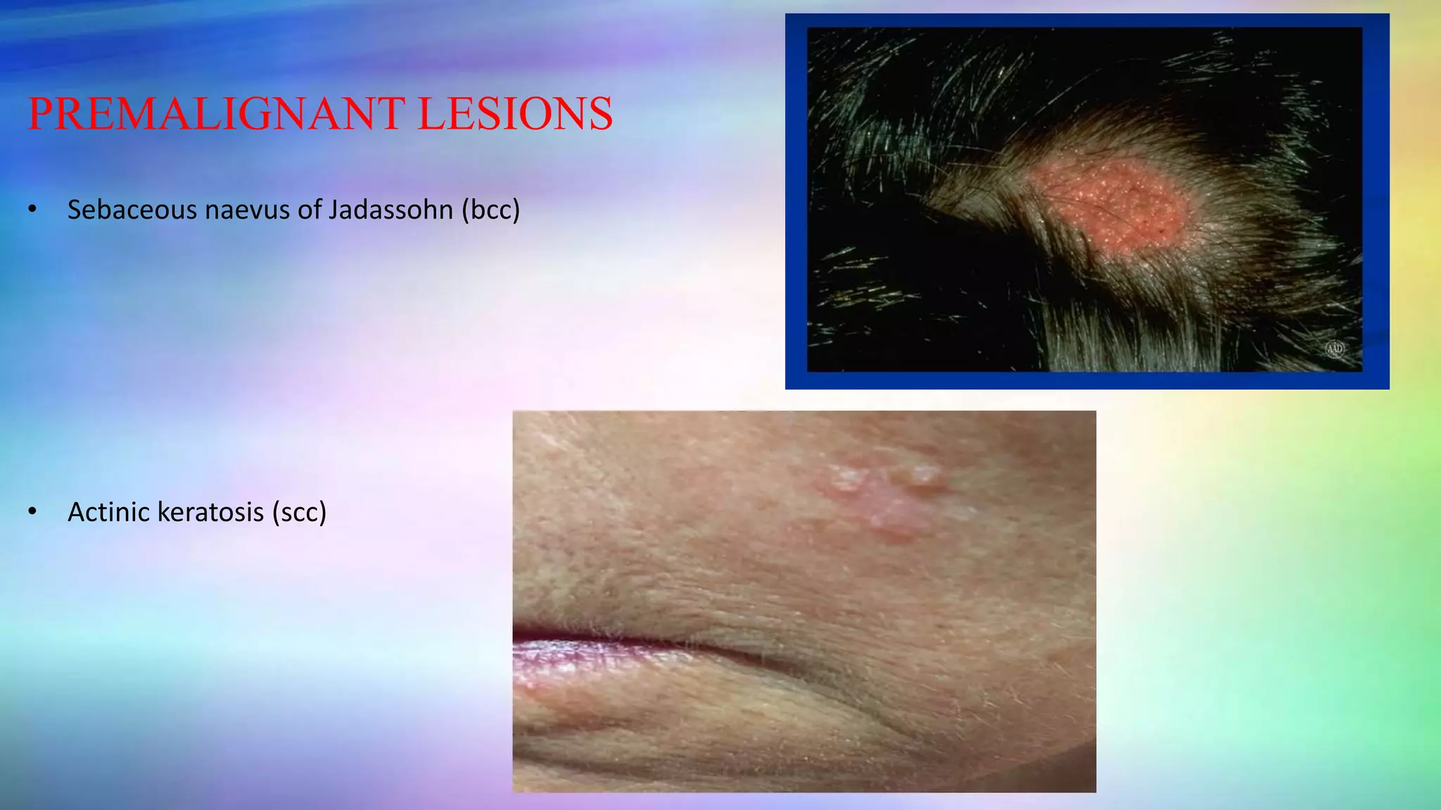 اhead and neck skin cancer | PPTX