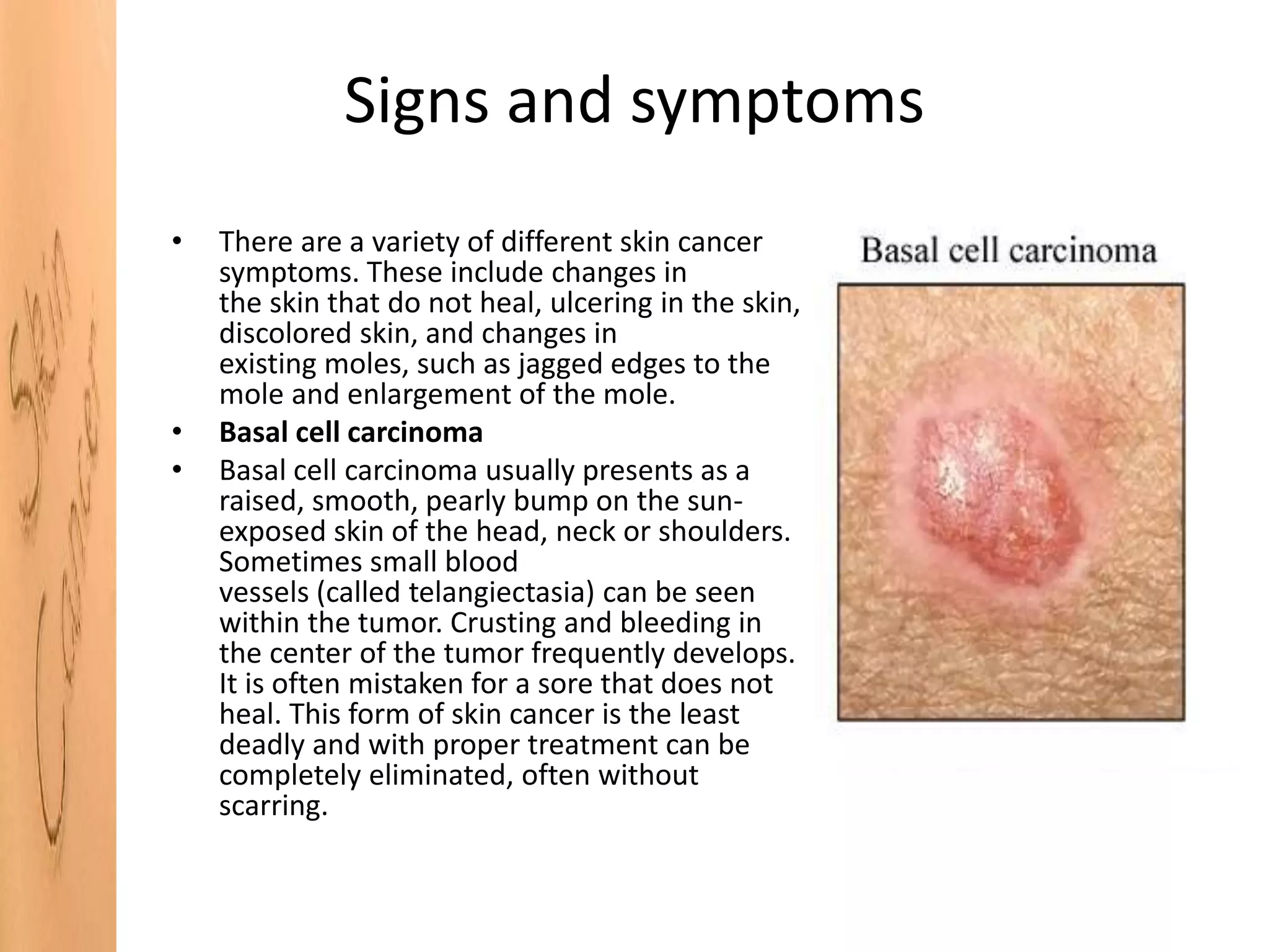 Skin cancer | PPTX