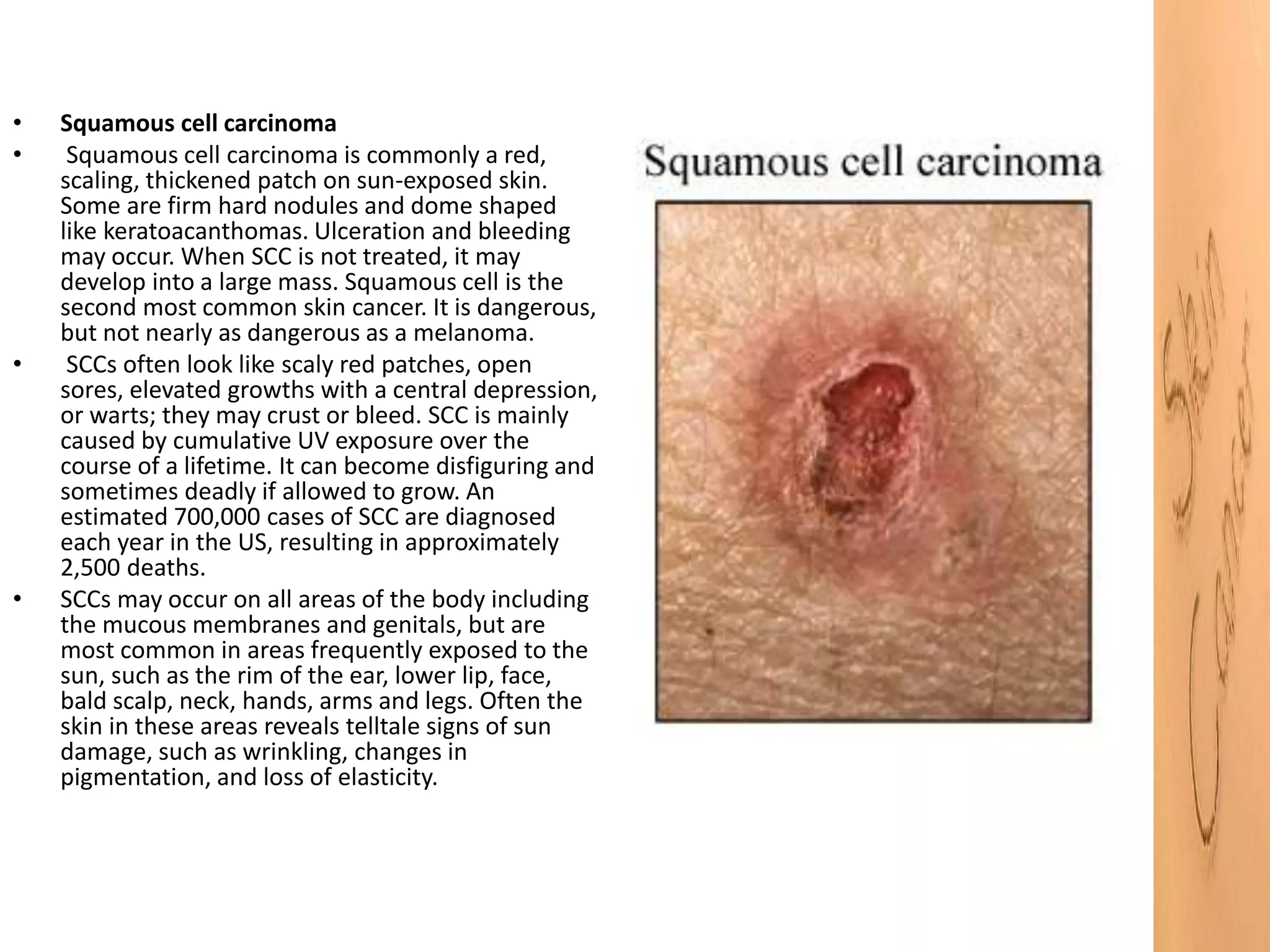 Skin cancer | PPTX
