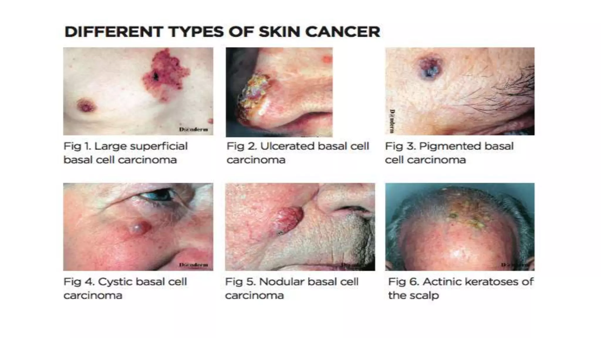 Skin cancer | PPT