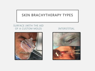 HDR brachytherapy for Non-Melanoma Skin cancers | PPTX