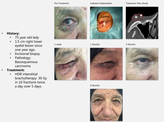 HDR brachytherapy for Non-Melanoma Skin cancers | PPT