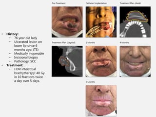 HDR brachytherapy for Non-Melanoma Skin cancers | PPTX