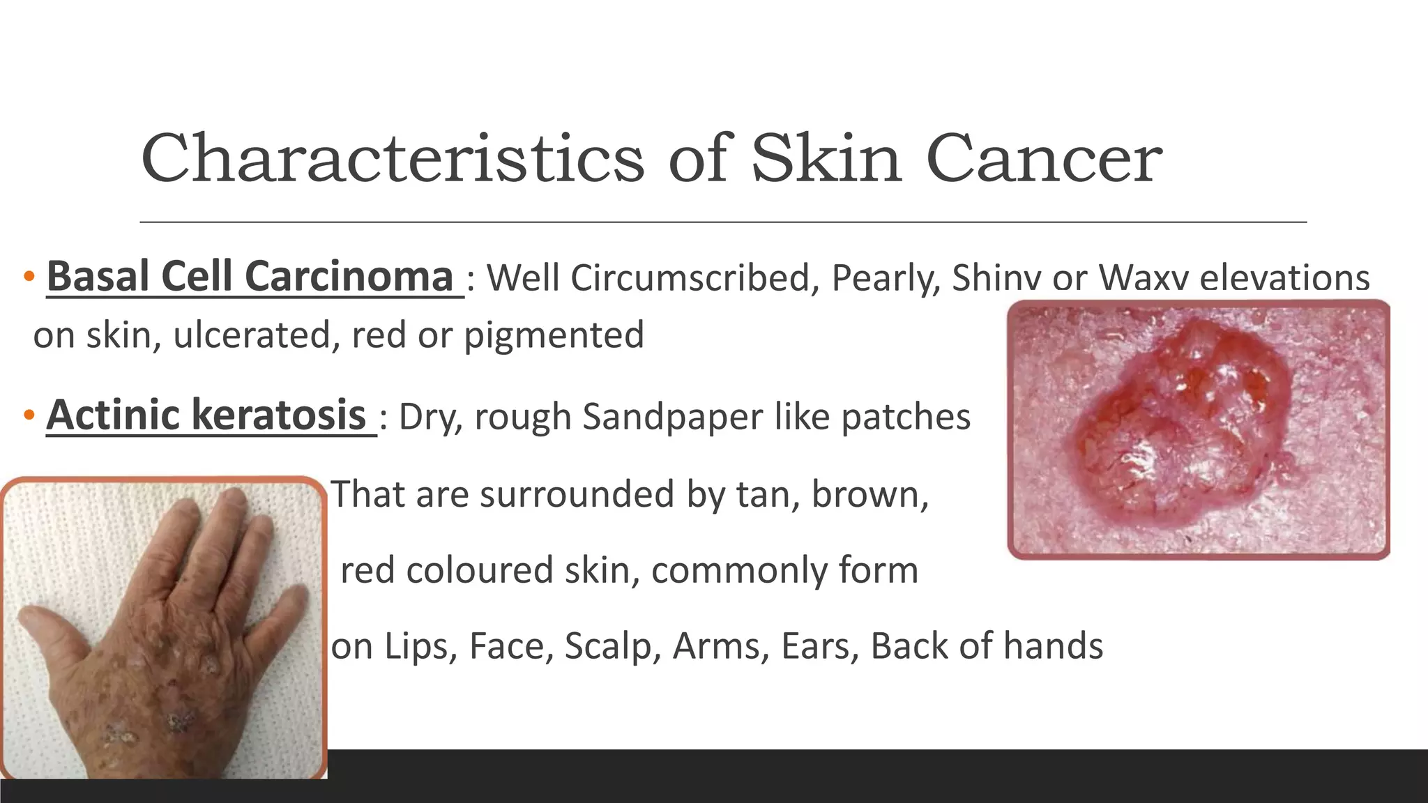 Skin Cancer | PPTX