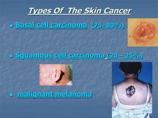 skin cancer .ppt