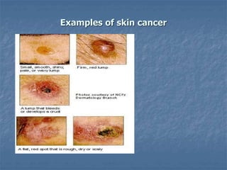 skin cancer .ppt