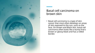 skin cancer non melanocytic dermatoscopy | PPTX