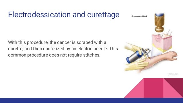 6 Effective Treatment Options that will Cure Skin Cancer