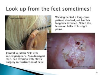 Skin Cancer And The Lower Limb | PPT