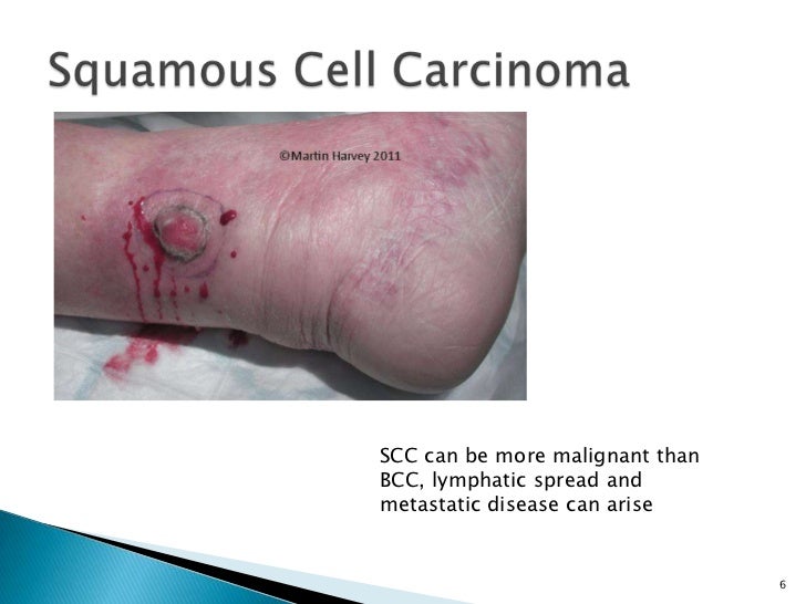 Skin Cancer And The Lower Limb