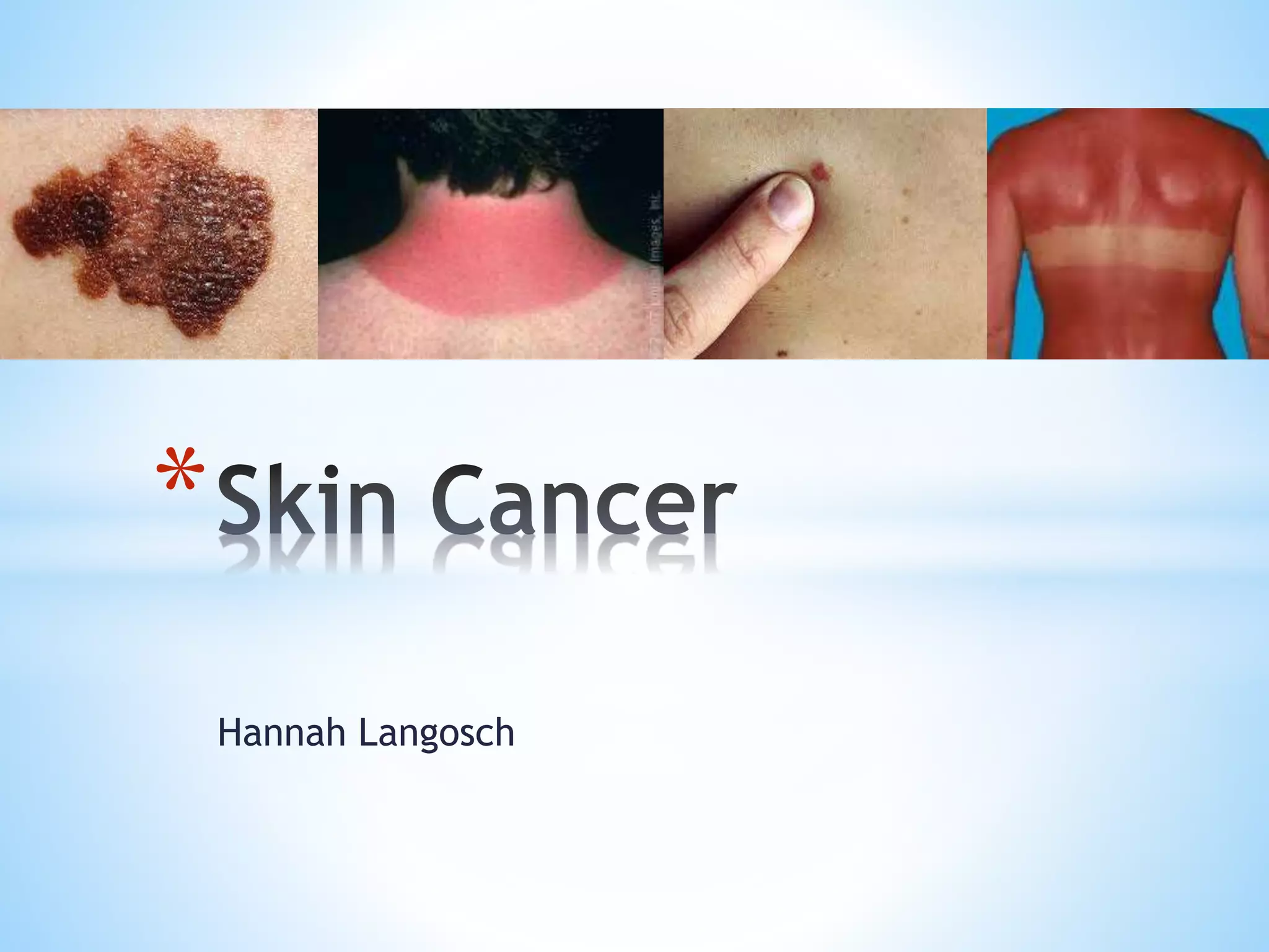 Skin Cancer | PPT