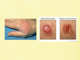 Skin cancers | PPTX