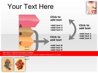 Skin Cancer Treatment Powerpoint Template | PPT