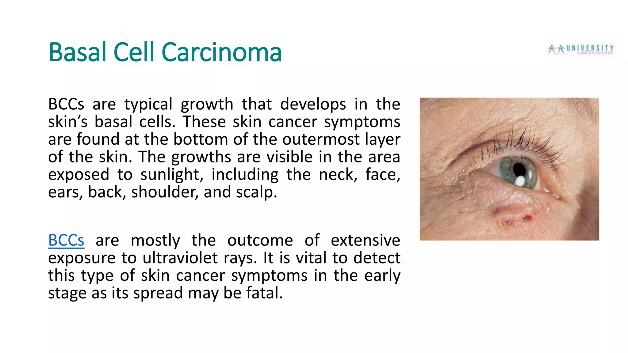 Skin Cancer Types | PPT