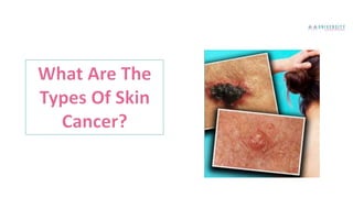 Skin Cancer Types | PPT