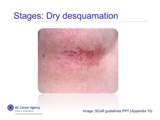 Skin care for radiotherapy | PPT