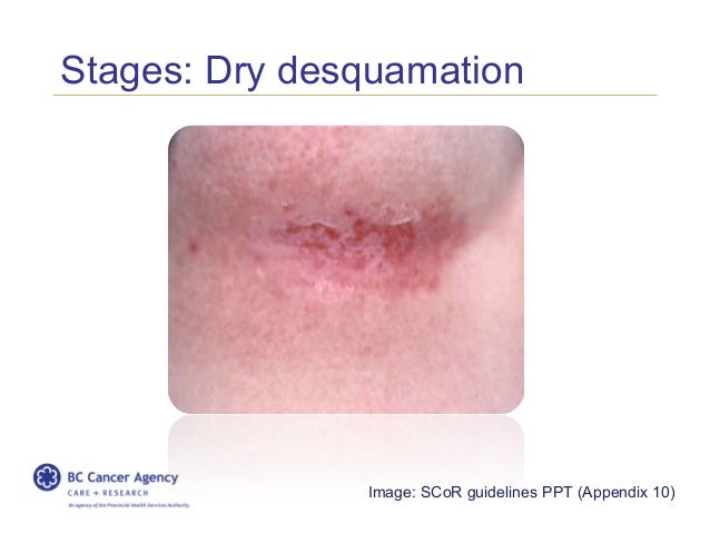 Skin care for radiotherapy