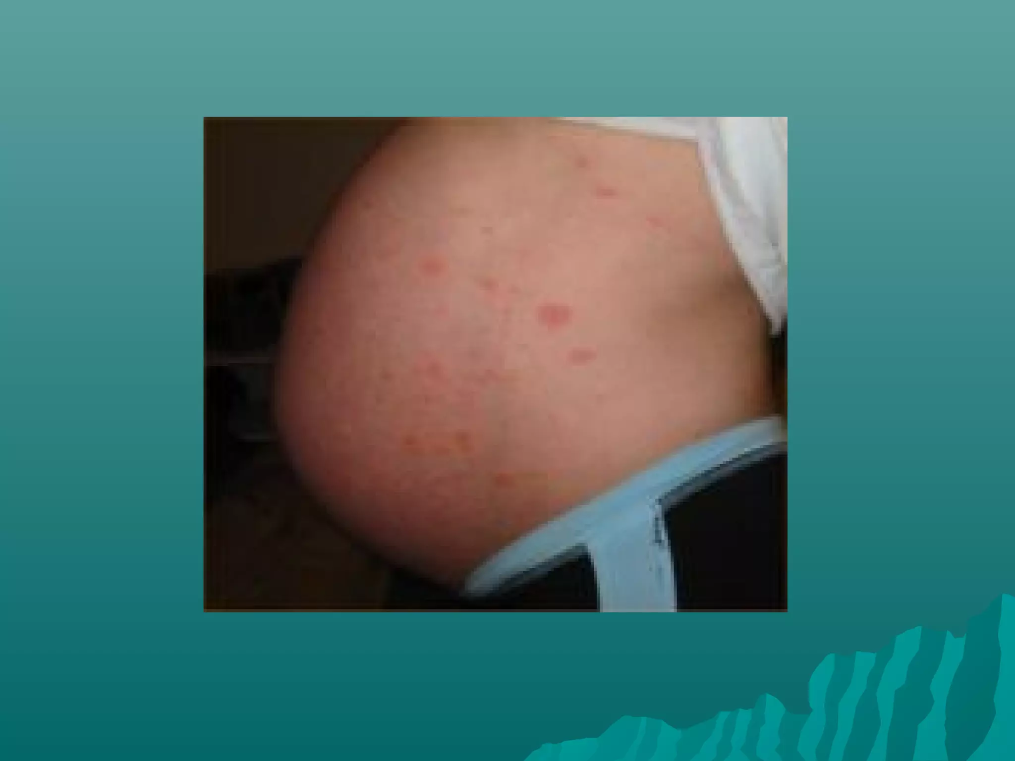 Skin changes and dermatoses of pregnancy | PPT
