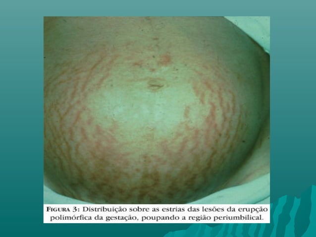 Skin changes and dermatoses of pregnancy | PPT | Pregnancy ...