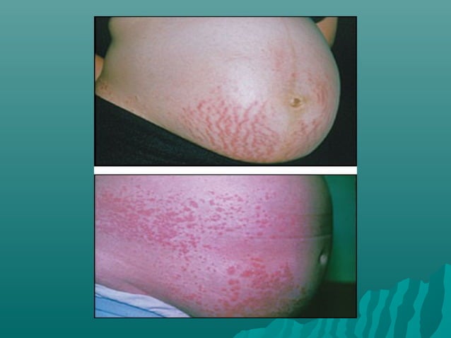 Skin changes and dermatoses of pregnancy | PPT