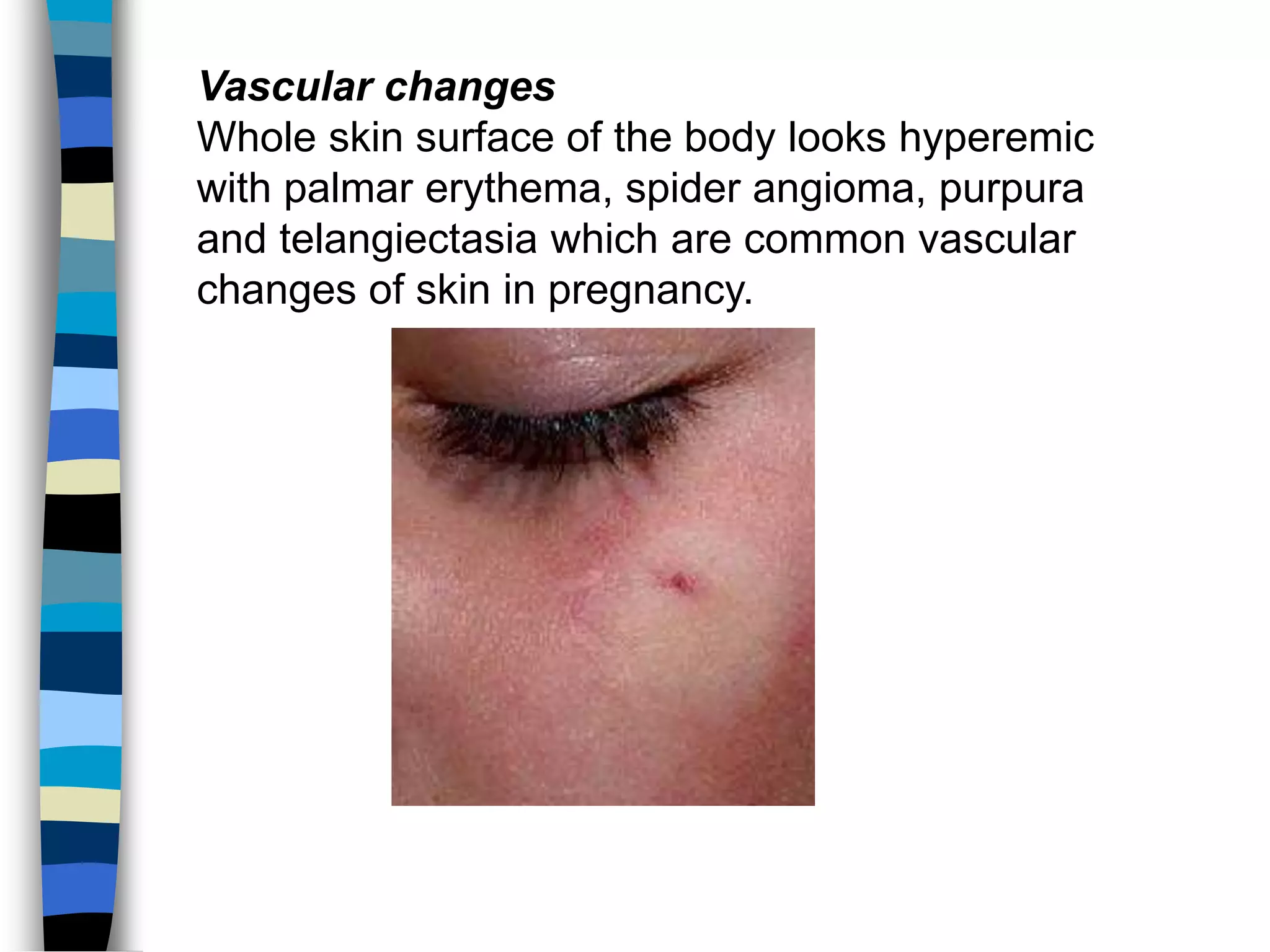 Skin changes and diseases in pregnancy | PPTX
