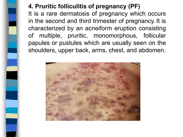 Skin changes and diseases in pregnancy | PPTX | Pregnancy ...