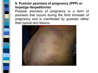 Skin changes and diseases in pregnancy | PPTX