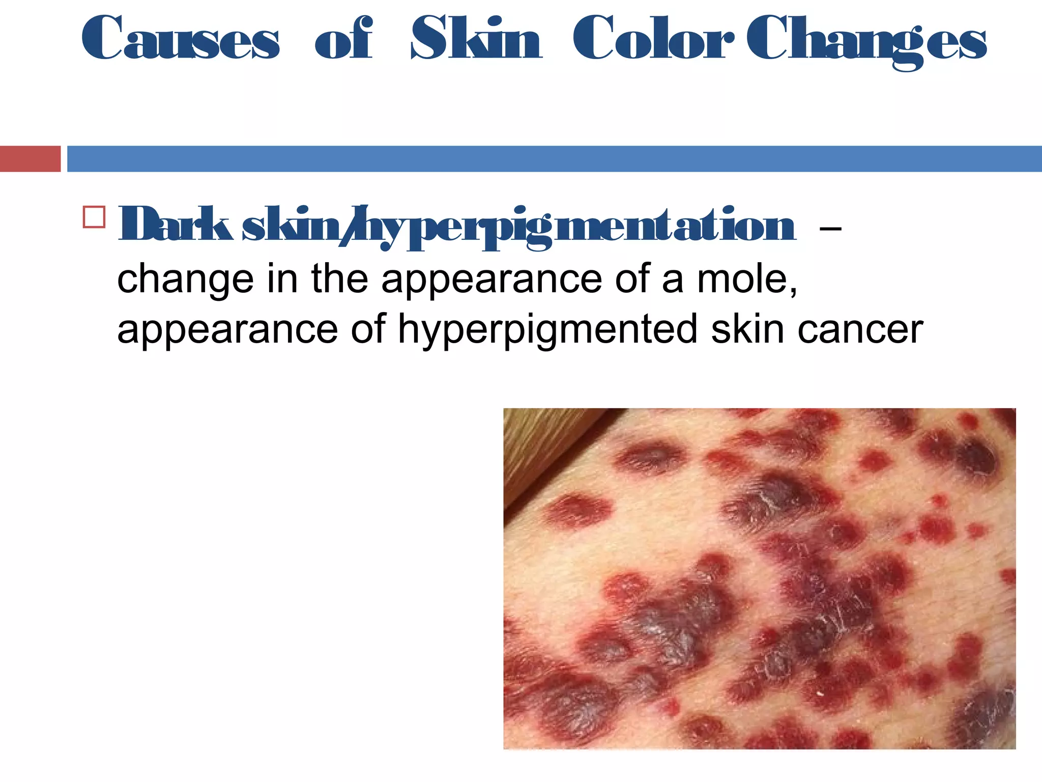 Skin Complications of Cancer by Roel Tolentino | PPT