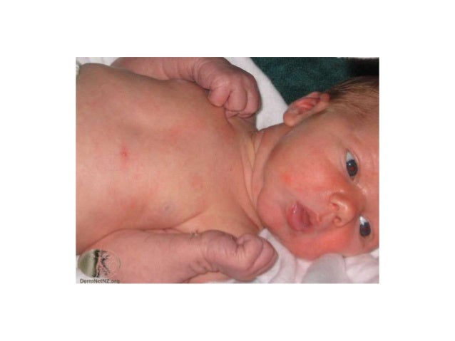 skin findings & skin diseases in newborn