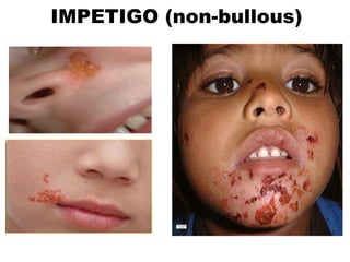 Skin disease ppt for nursing student | PPTX