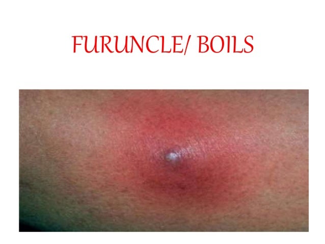 Furuncles Carbuncles Symptoms Causes Treatment Tibot