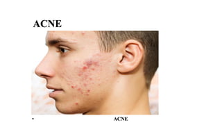 common skin disorders by rustom raju,University of Rajshahi | PPT